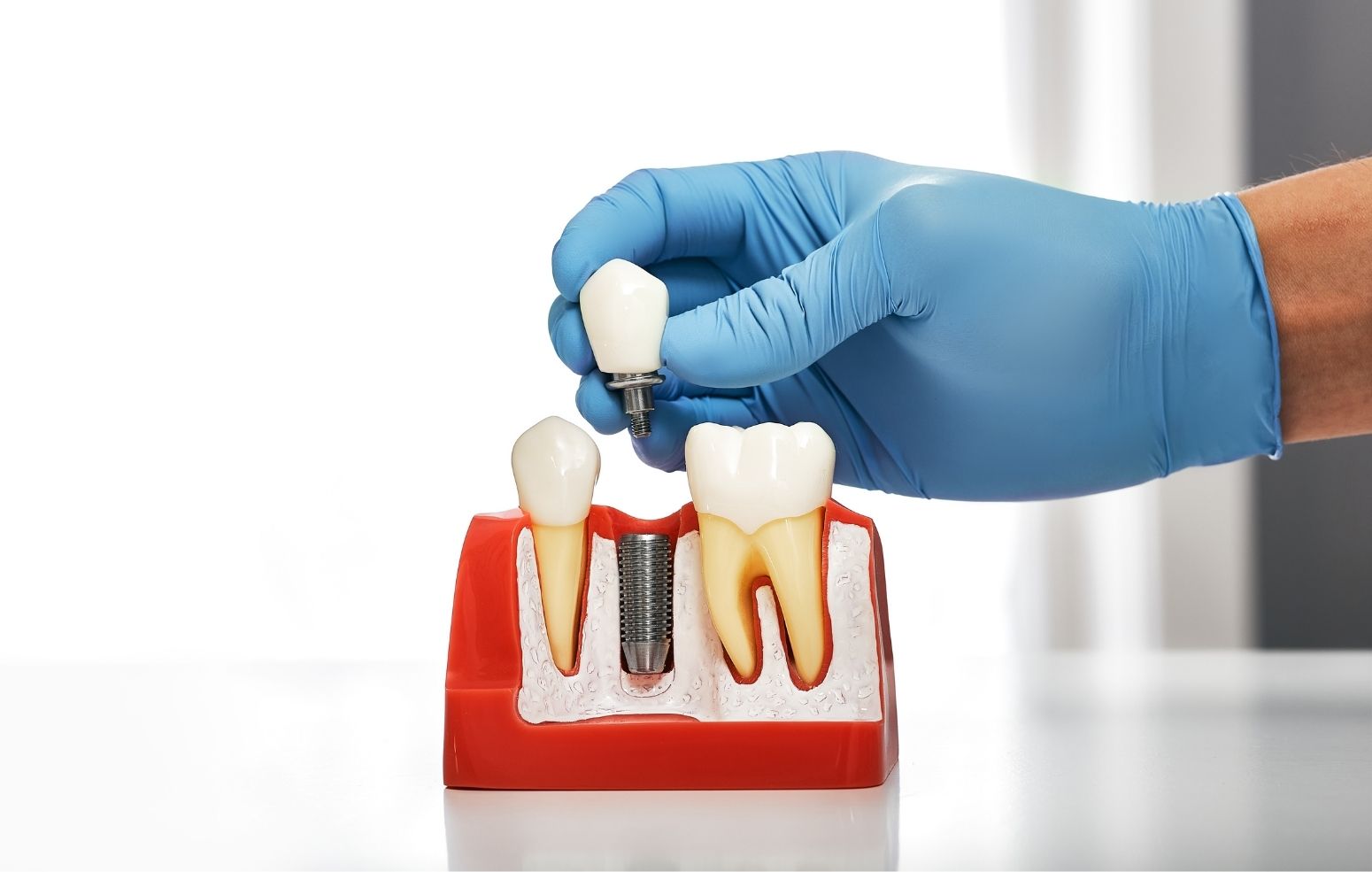 Affordable Dental Implants: Discover Panama's Solutions